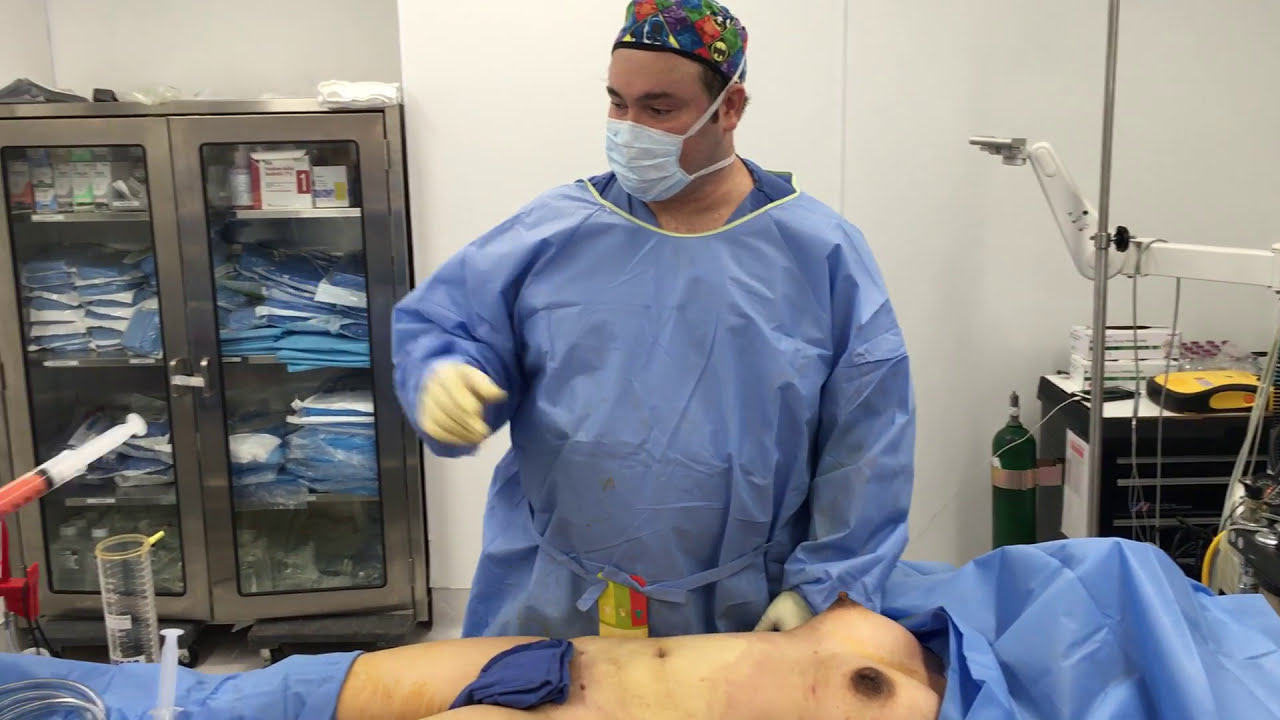 Liposuction of Abdomen and Breast Fat Transfer with Dr. Kenneth Hughes ...