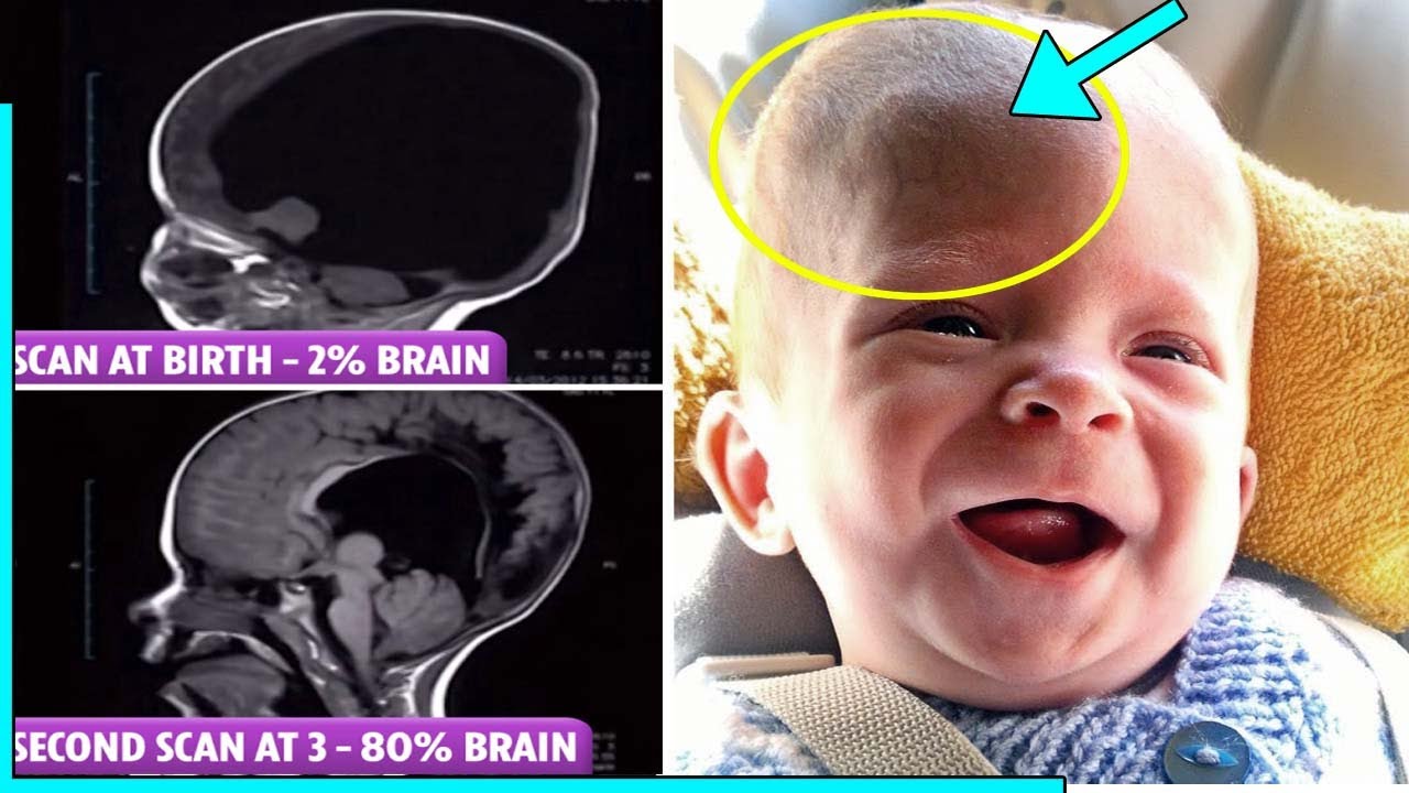THE BOY WITH 'NO BRAIN' Boy born with MISSING brain defies huge odds to ...