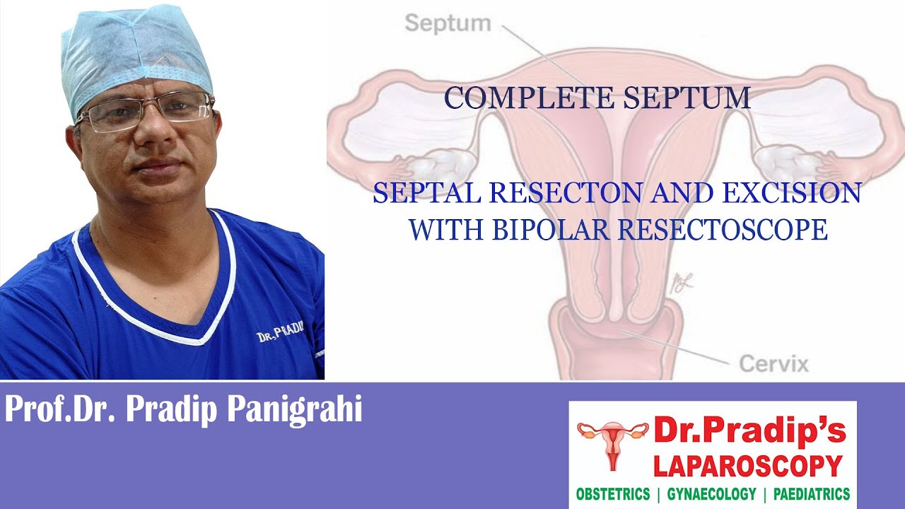 Complete Septum septal resection and excision with bipolar resectoscope ...