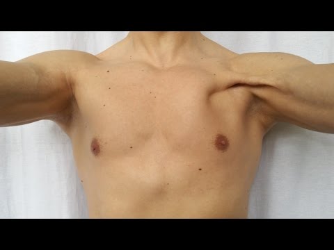 Ruptura de muschi pectoral mare si reconstructia lui ▪ Inaine si dupa