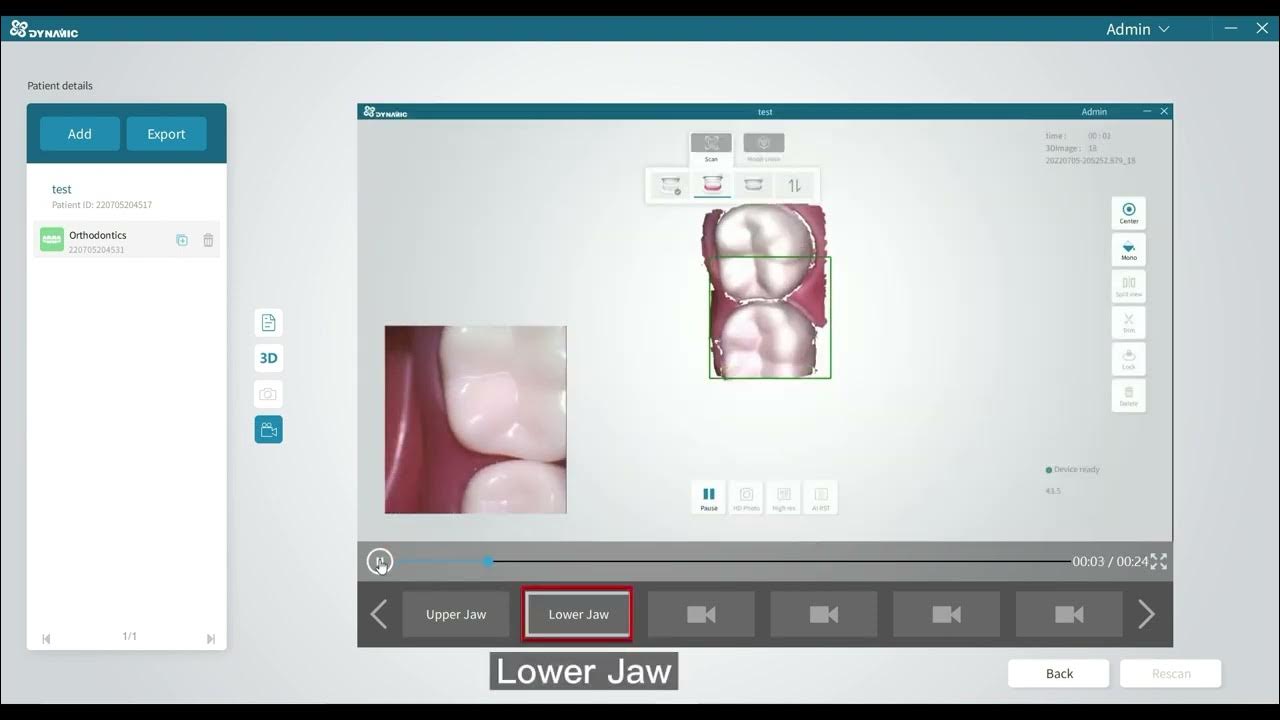 DYNAMIC DDS300 Intraoral Scanner -- Scanning Playback Function - YouTube