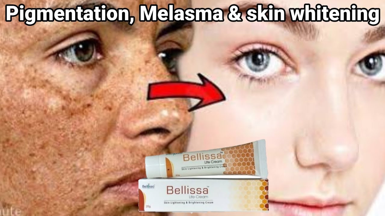 चेहरे की काली परत को हटाकर बेदाग गोरा करता है | Bellissa lite cream ...