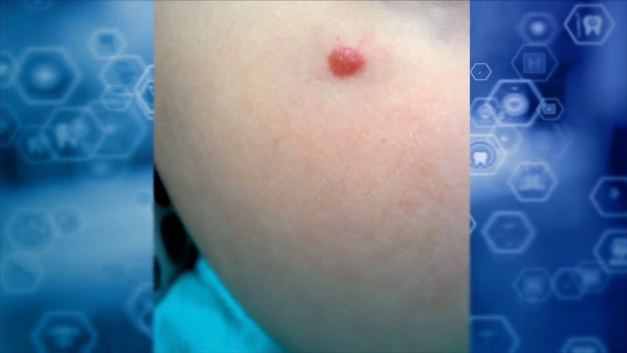 How To Check Your Child s Moles And When To Worry YouTube how-to-check-your-child-s-moles-and-when-to-worry-youtube