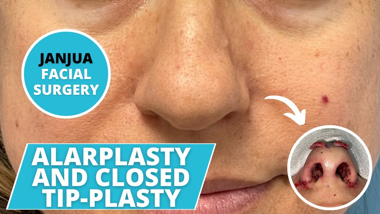 ALARPLASTY AND CLOSED TIP-PLASTY- DR. TANVEER JANJUA - NEW JERSEY - YouTube