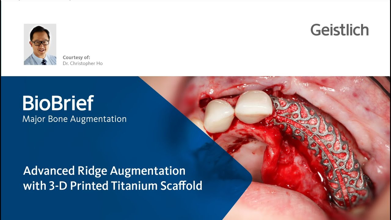 Major Bone Augmentation -Advanced Ridge Augmentation with 3-D Printed ...
