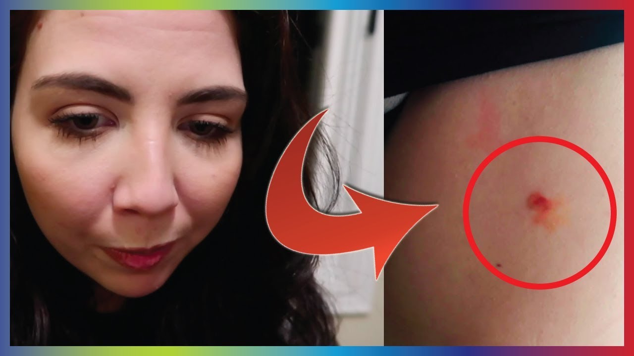 What Is This Mark On Her Back - YouTube