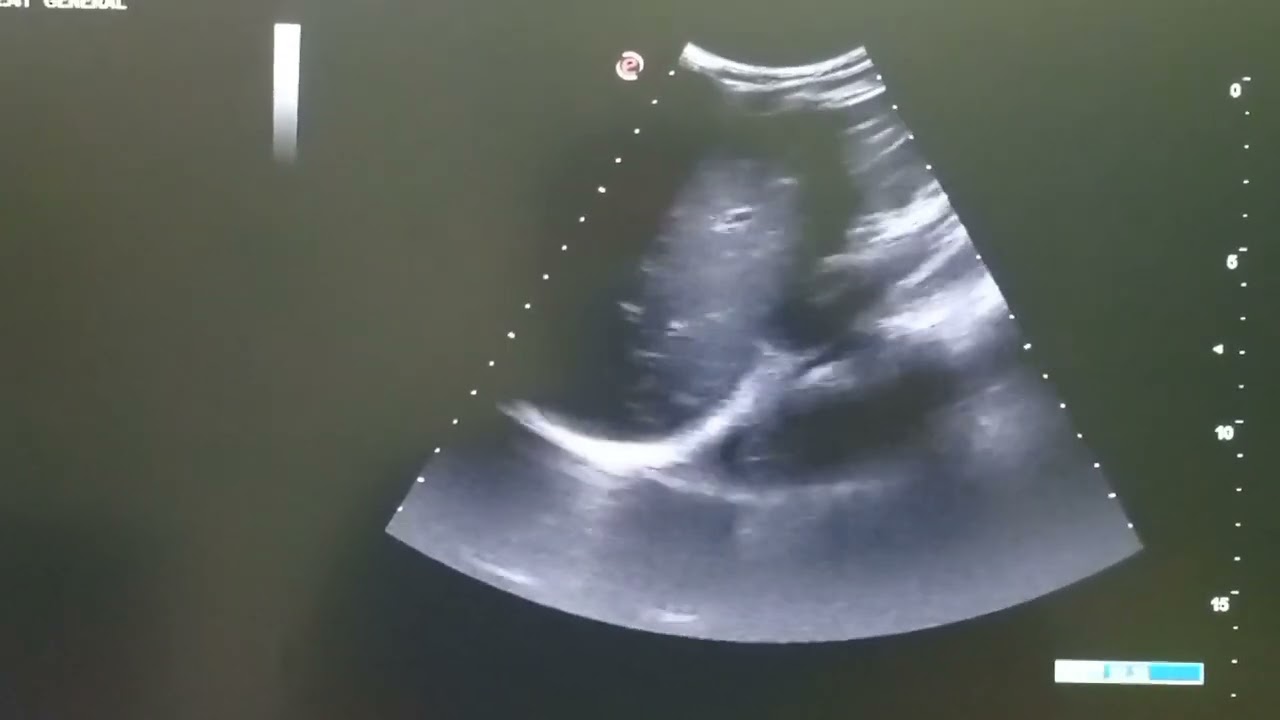 Acute Hepatitis Ultrasound | Starry sky appearance of Liver - YouTube