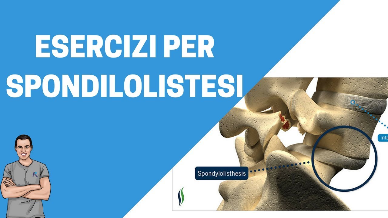 Spondilolistesi: quali esercizi fare - YouTube