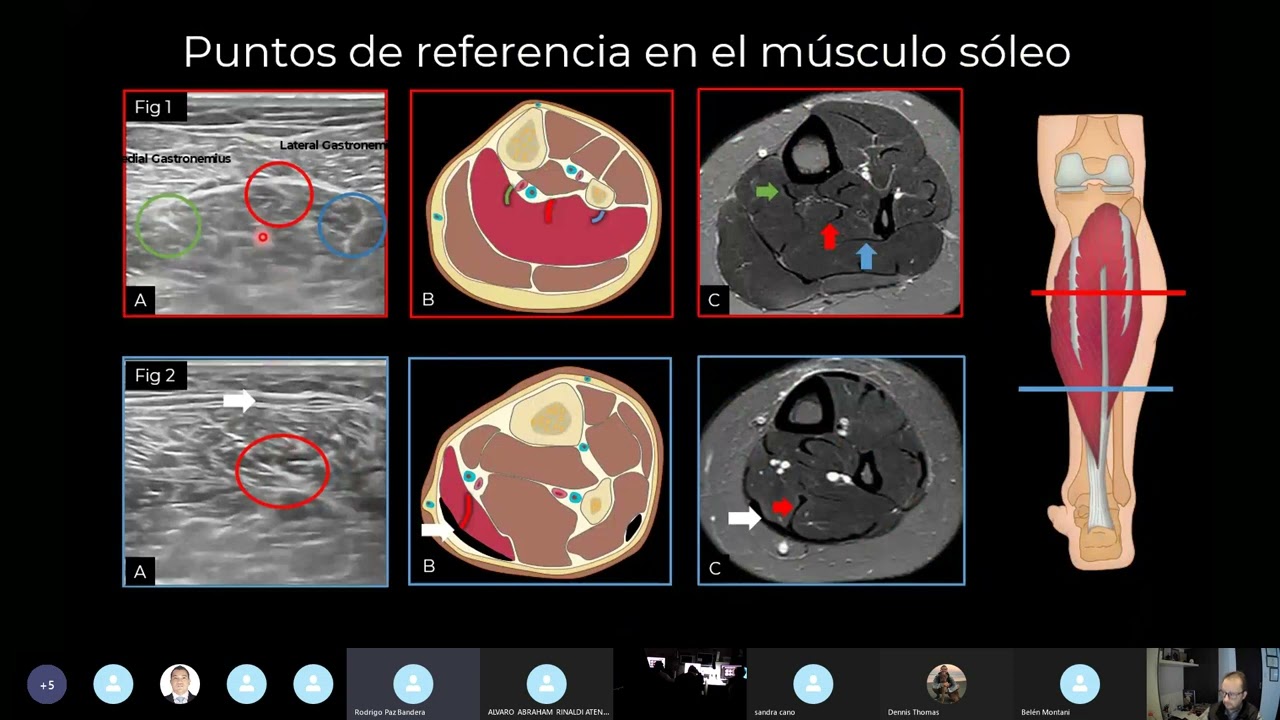 Lesiones del Sóleo y dolor posterior de la pierna - YouTube