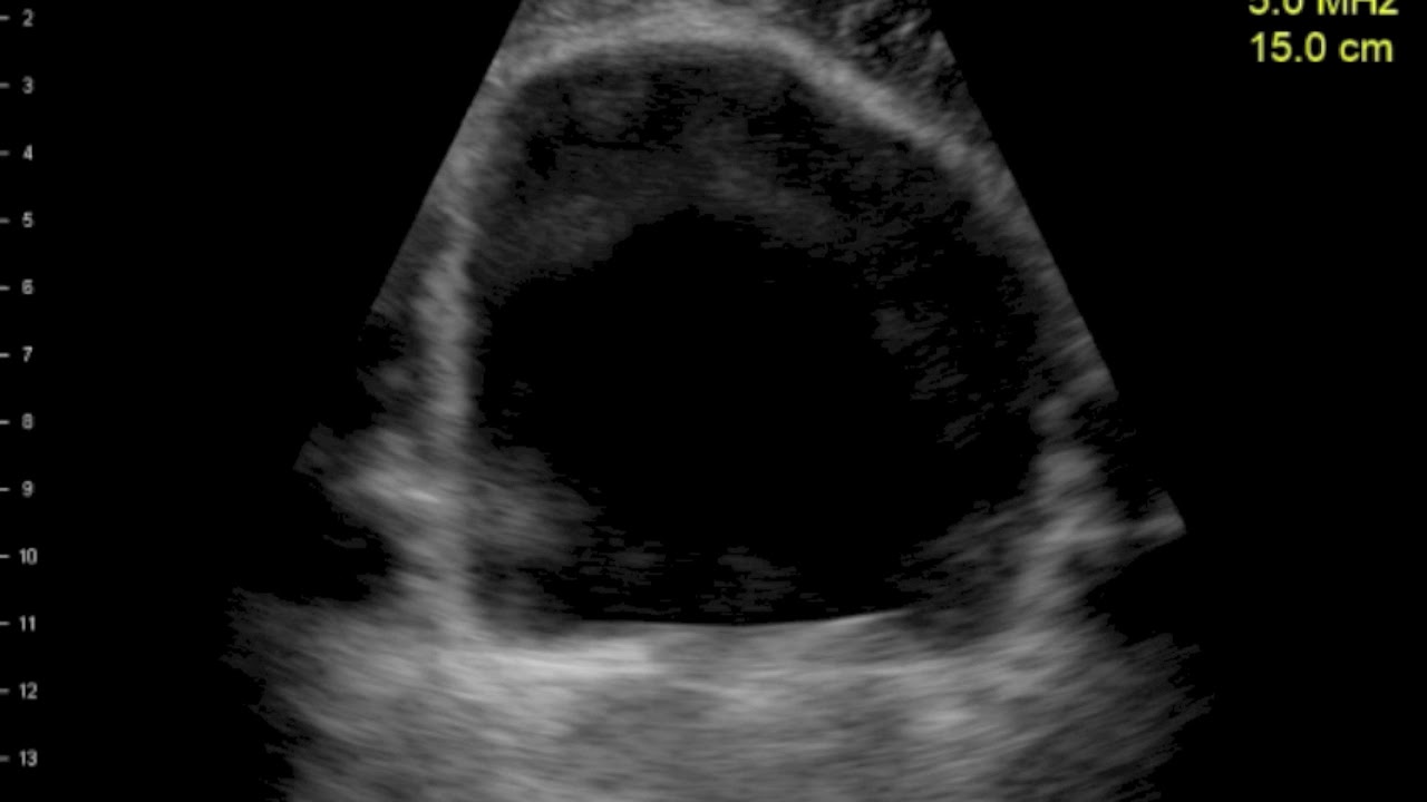 Interson UltraSound: Bladder - YouTube
