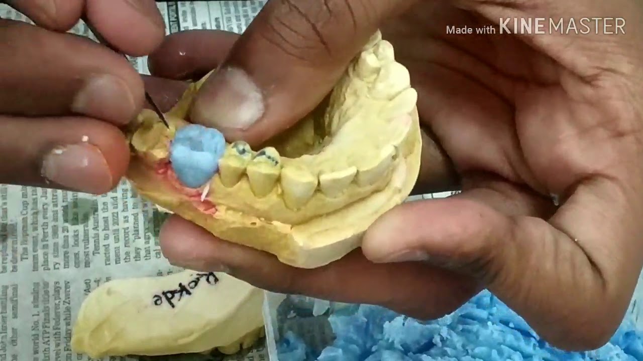 Wax Pattern Techniques.. @ SMBT Institute Of Dental Sciences And ...