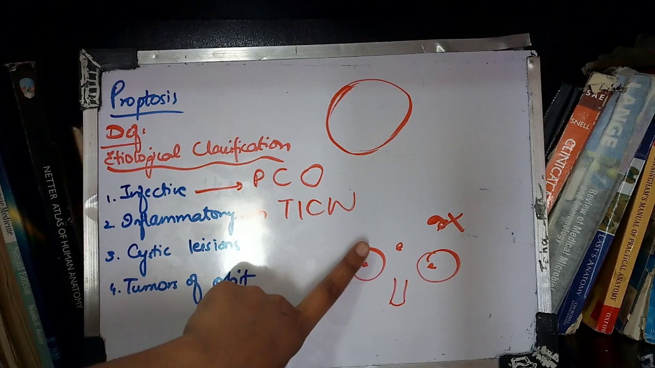 PROPTOSIS very important topic with MNEMONICS to learn - YouTube
