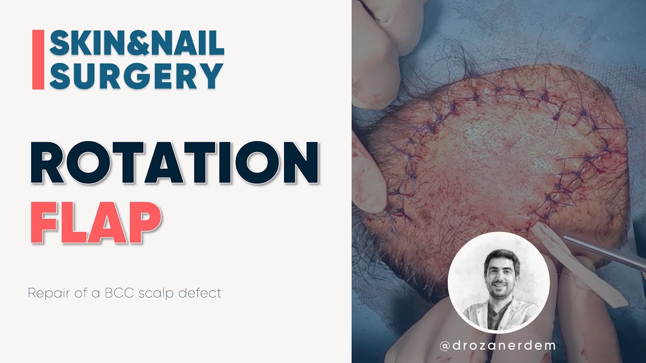 Scalp Rotation Flap: Reconstruction of a Basal Cell Carcinoma Scalp ...