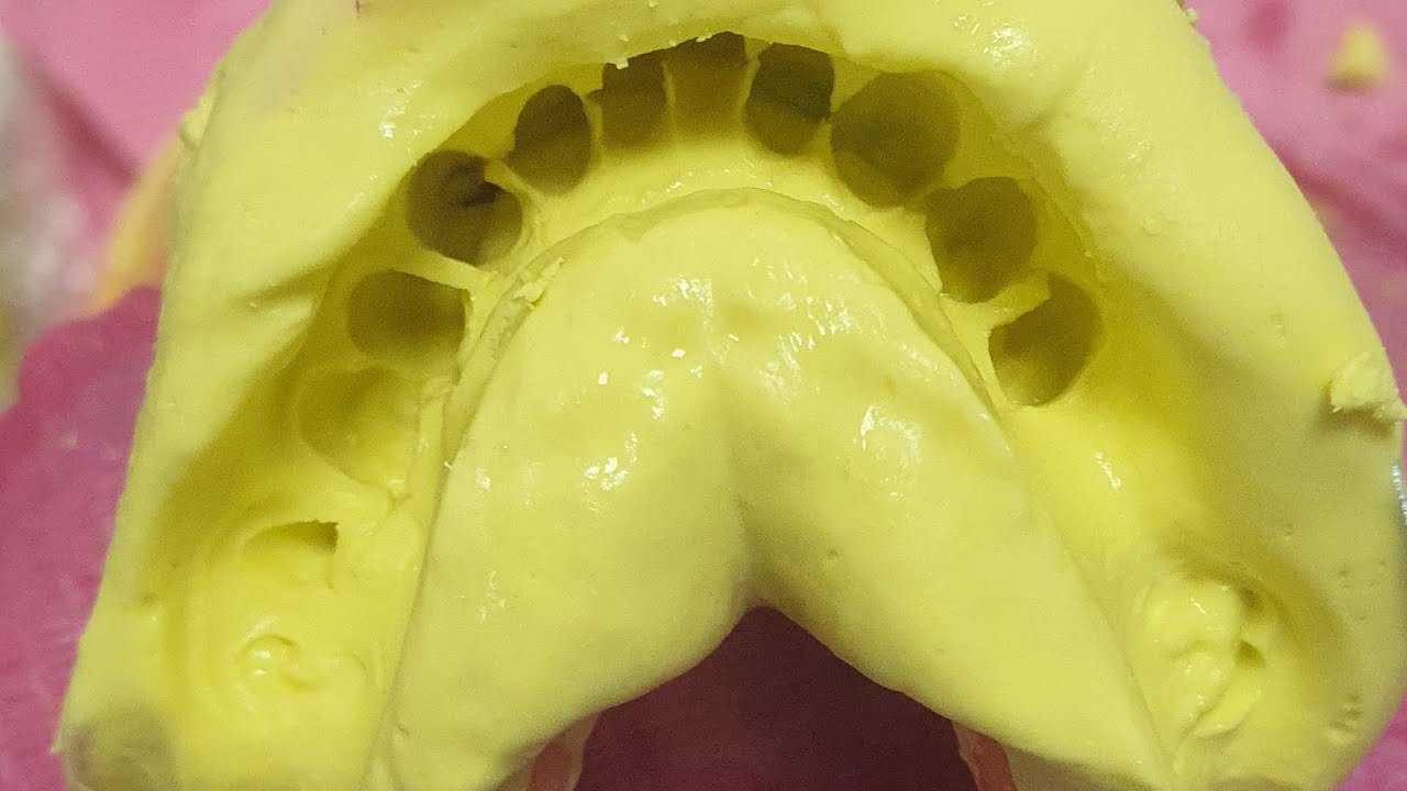 Primary impression ( removable prosthodontics) - YouTube