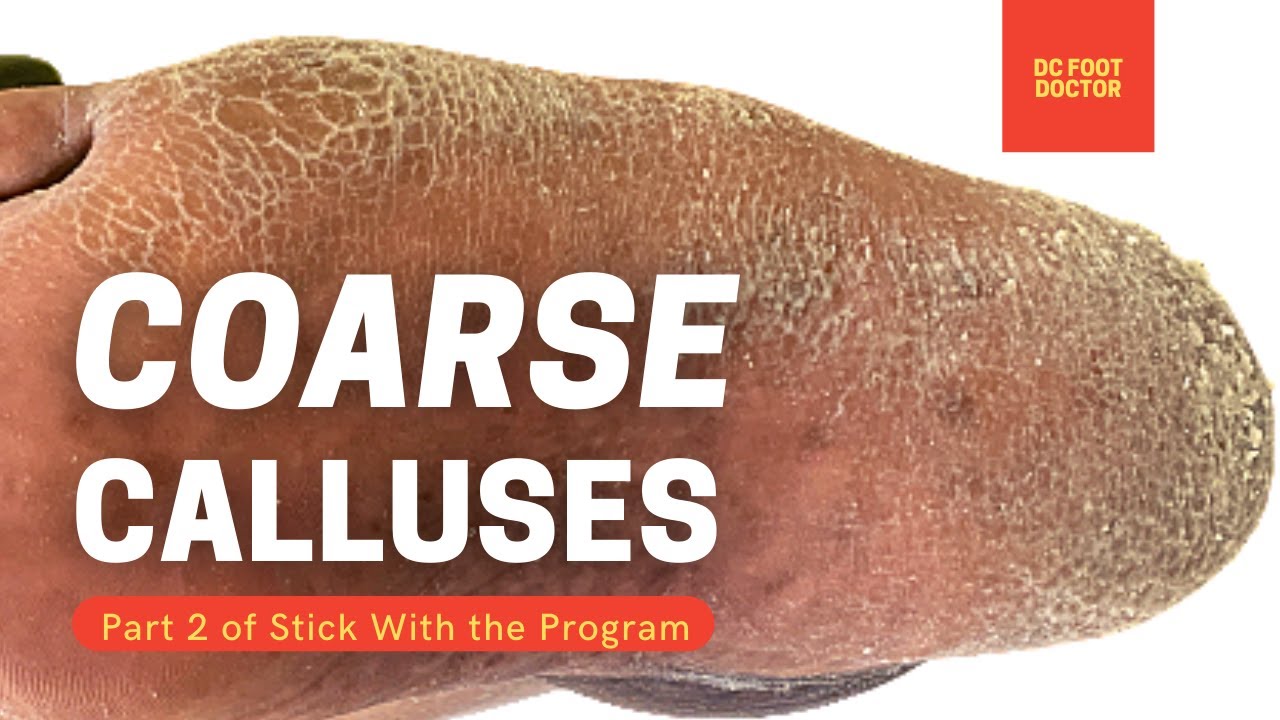 Coarse Calluses! Stresses in the Feet, Plantar Fasciitis, and Heel ...