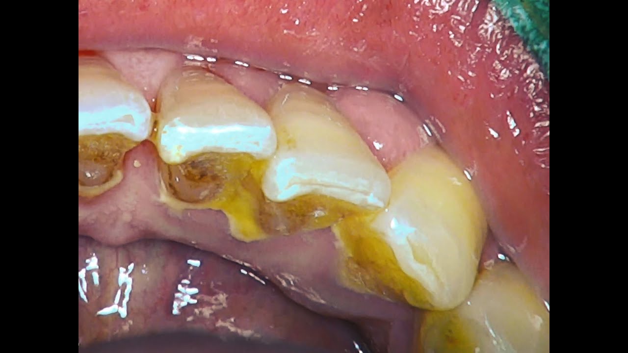 remove tartar calculus scaling 치석제거 잠실새내치과 잠실새내역치과 - YouTube