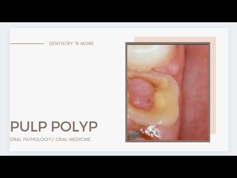 PULP POLYP || CHRONIC HYPERPLASTIC PULPITIS - YouTube