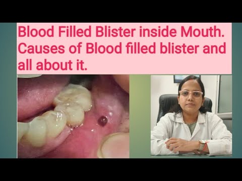 Blood filled Blisters.Why Blood filled blisters inside mouth &How it ...
