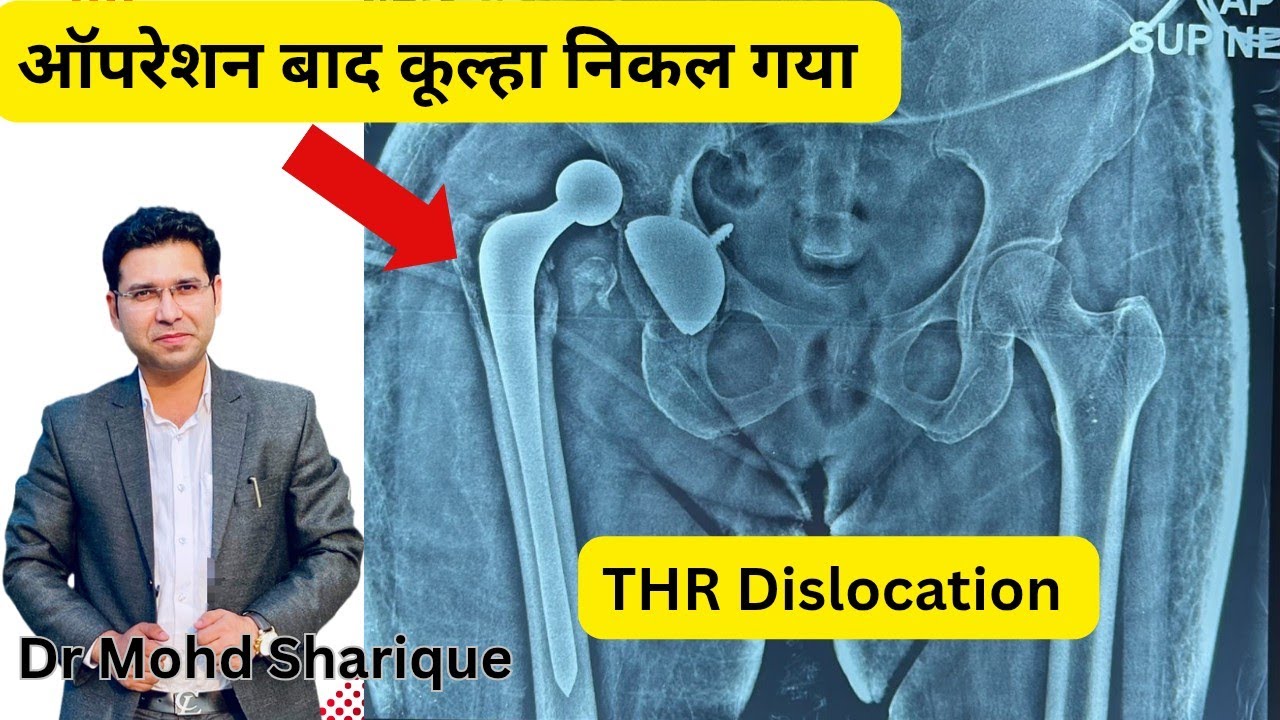 THR dislocation | ऑपरेशन के बाद कूल्हा निकल गया सॉकेट से # ...