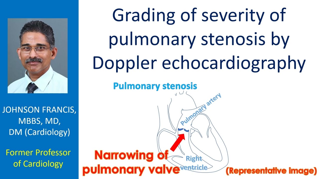 Infundibular Pulmonary Stenosis Workup Laboratory Studies Infundibular