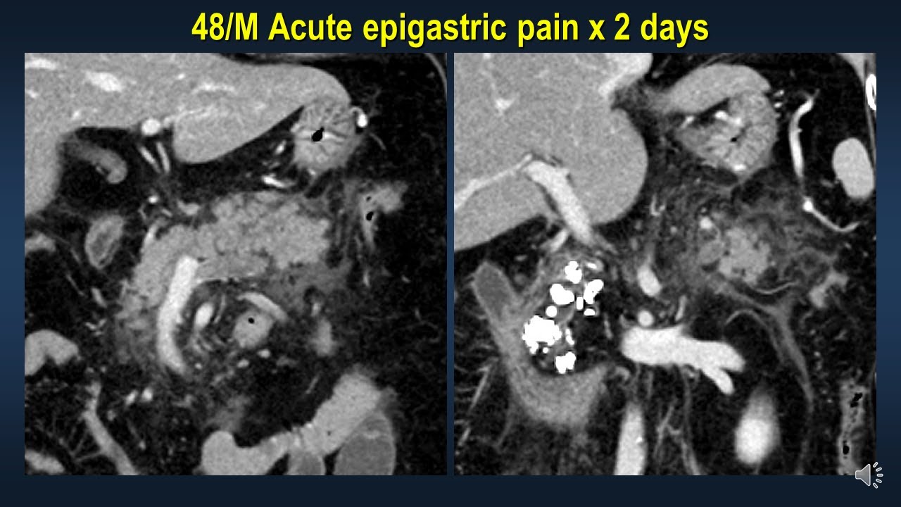 Pancreatitis associated with pancreas divisum - YouTube