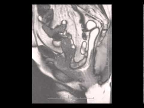 Dynamic MRI showing Enterocele - YouTube