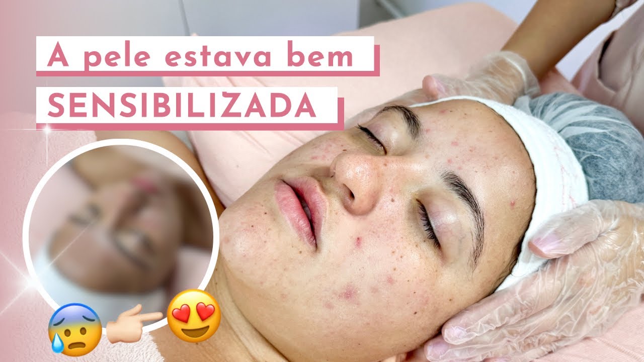 PROTOCOLO FACIAL PARA TRATAMENTO DE ACNE - YouTube