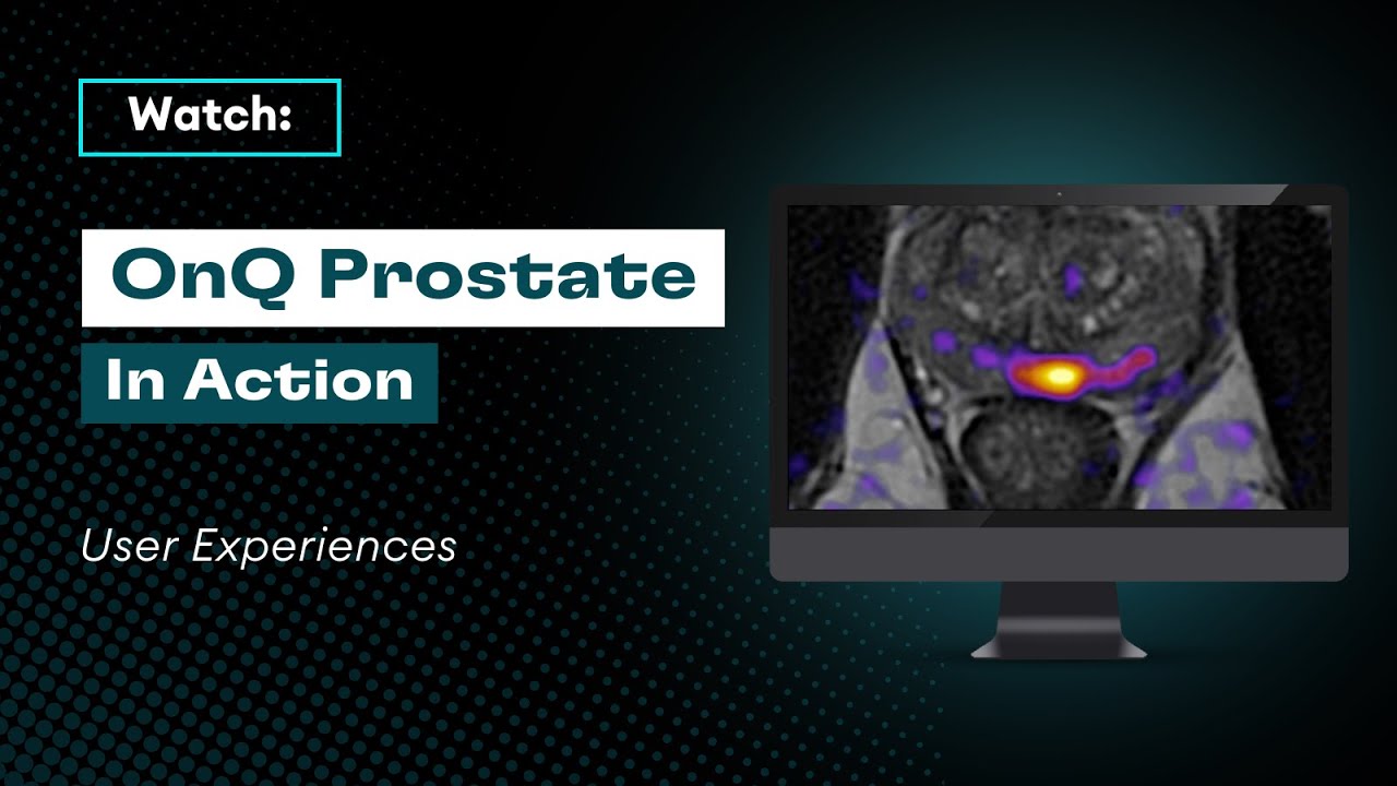 OnQ Prostate in Action: User Experiences - YouTube