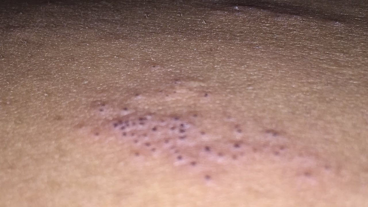 VLOGMAS WEEK 2: SHINGLES OUTBREAK - YouTube