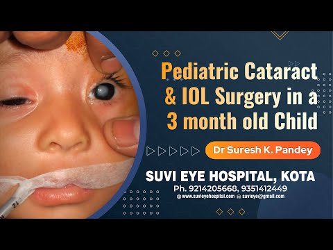 Pediatric Cataract & IOL Surgery in a 3 month old Child SuVi Eye Kota ...