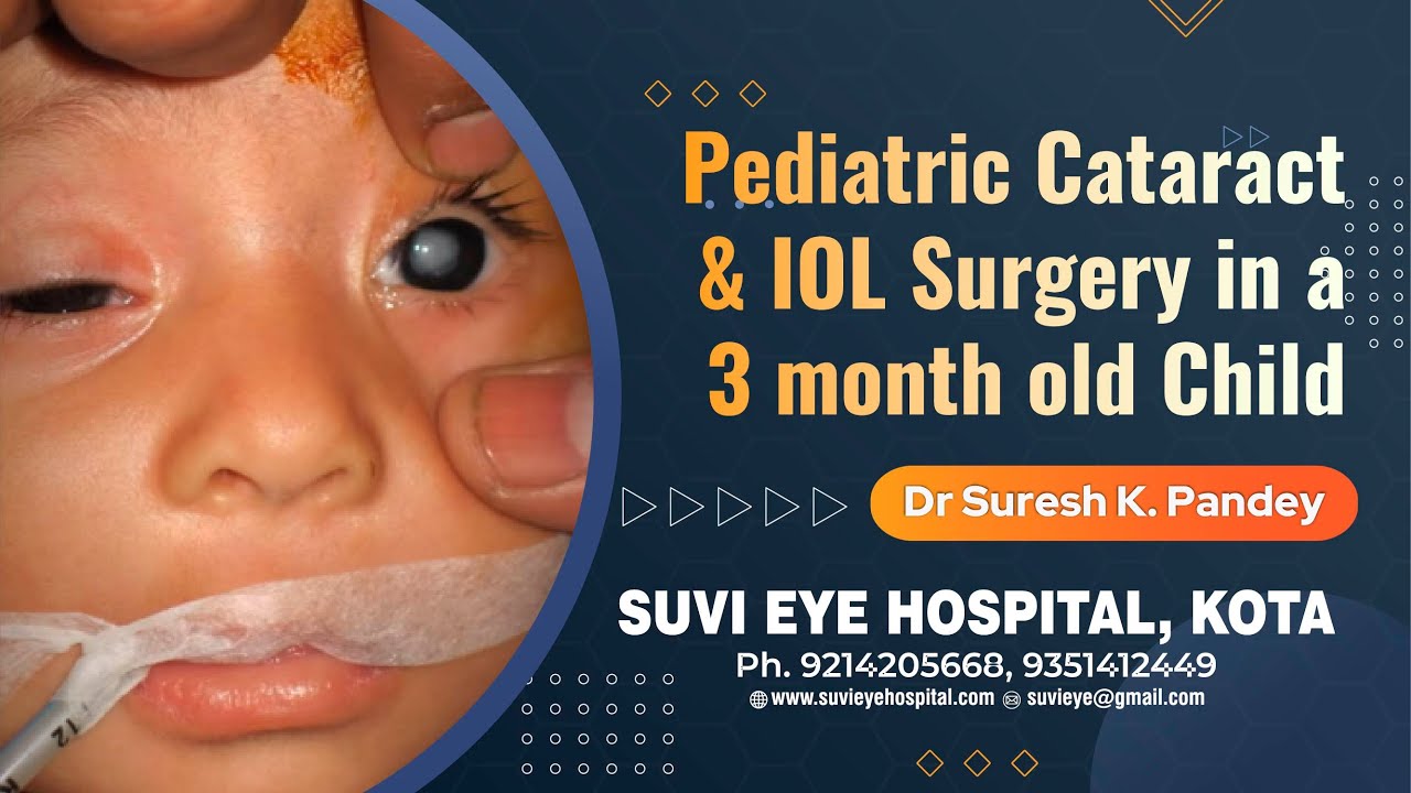 Pediatric Cataract & IOL Surgery in a 3 month old Child SuVi Eye Kota ...