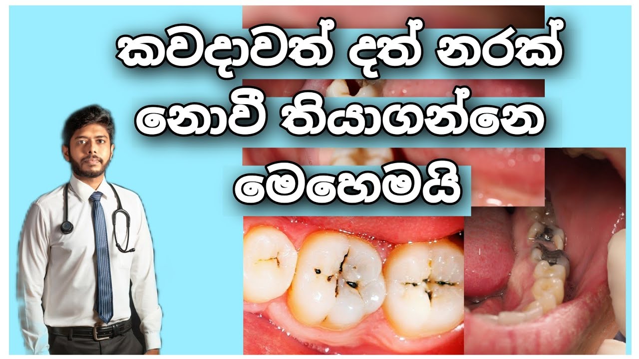 දත් නරක්වීම හා කුහර ඇතිවීමෙන් වලක්වාගමු dental caries sinhala/ dath ...