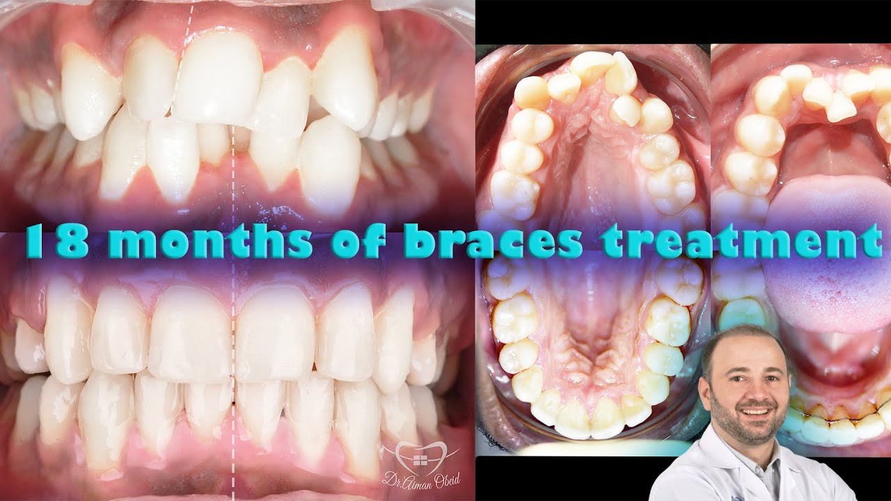 Sever teeth crowding and bite problem has been solved in 1.5 year ...