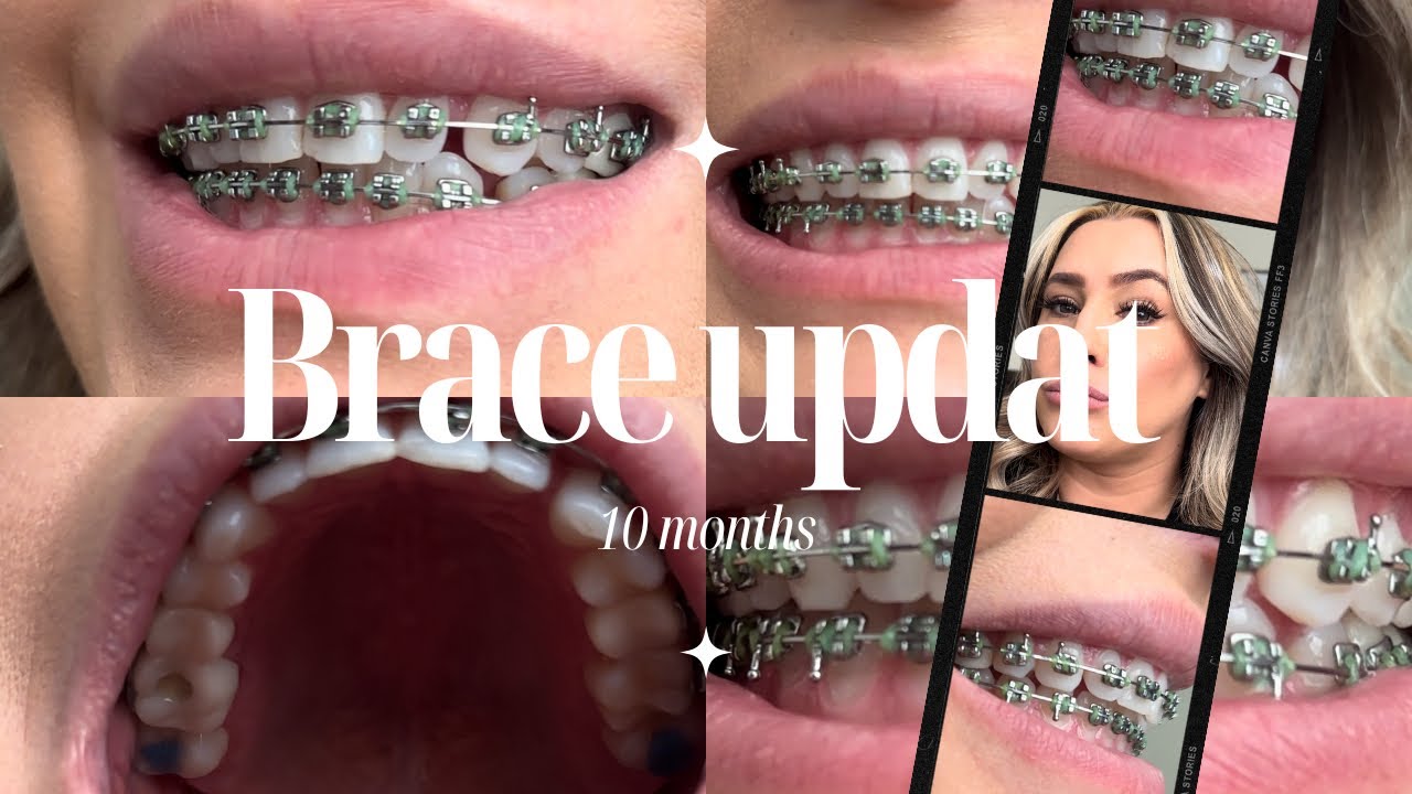 10 month brace update and dental work - YouTube