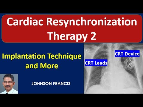 Cardiac Resynchronization Therapy - Implantation Technique and CRT ...
