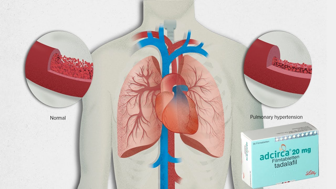 Pulmonary Arterial Hypertension |Adcirca Best Medicine Use For ...