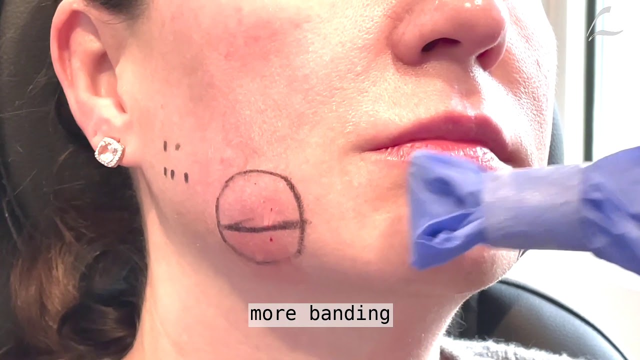 Dallas Kybella Procedure for Jowls by Dr. Lam - YouTube