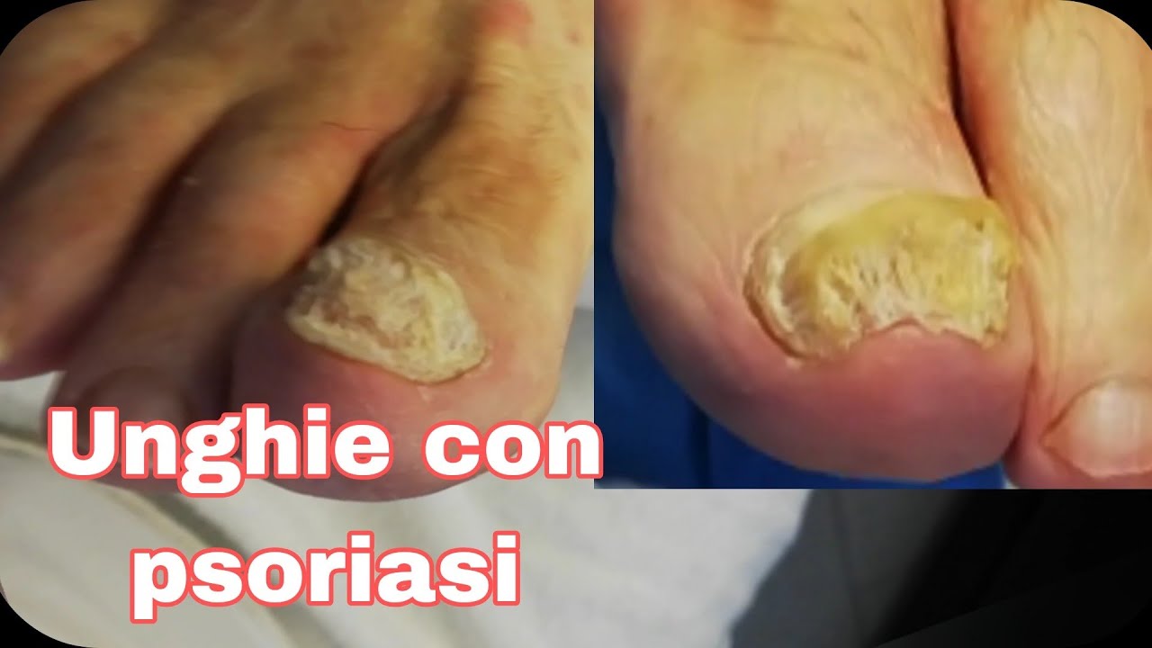 "Trasformazione unghie con psoriasi : Cura e Autostima" - YouTube