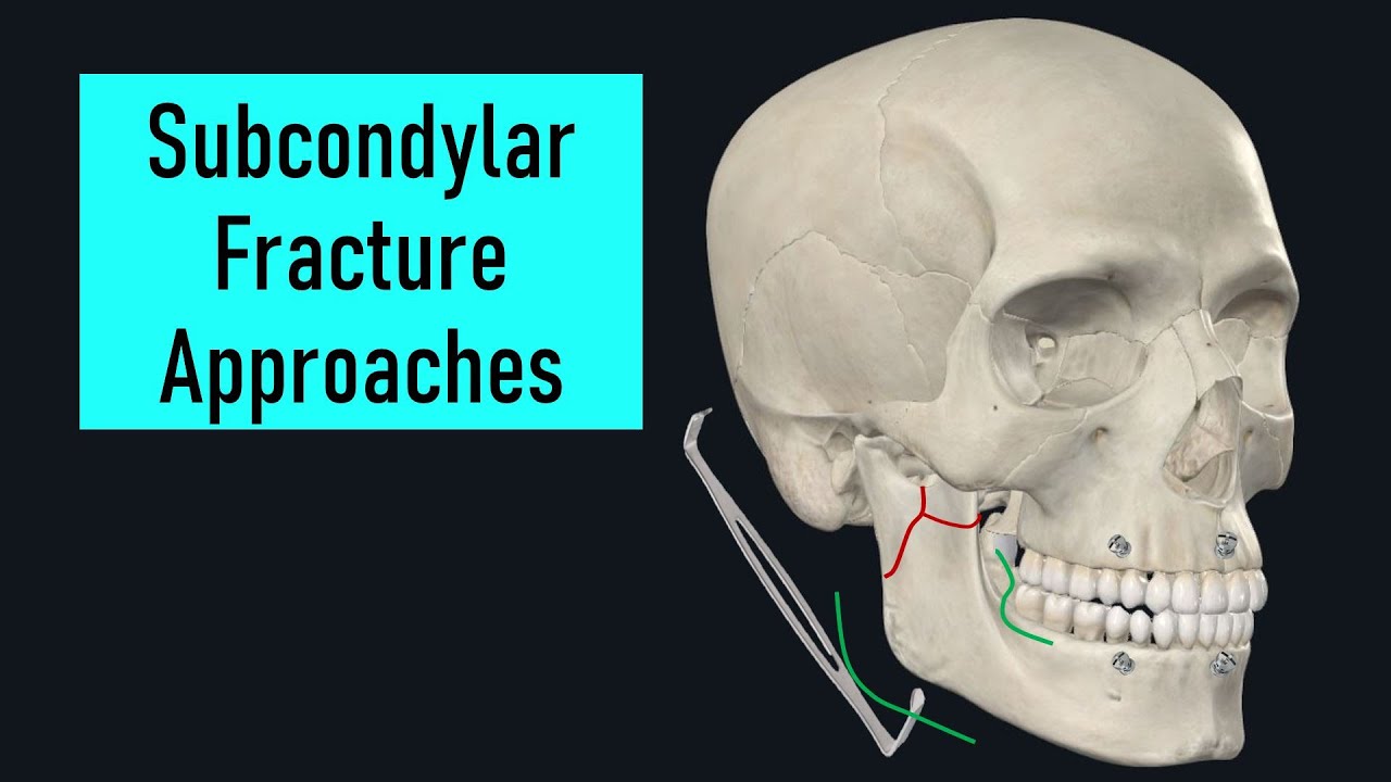 Surgery: Subcondylar Fracture Approaches: Intraoral & External ...