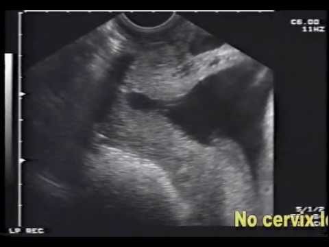Cervical incompetence revealed live.mov - YouTube