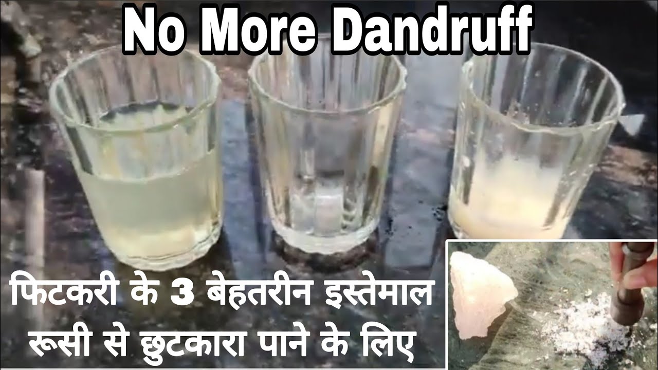 3 Uses Of Fitkari For Dandruff Removal || रूसी का इलाज करें फिटकरी से ...