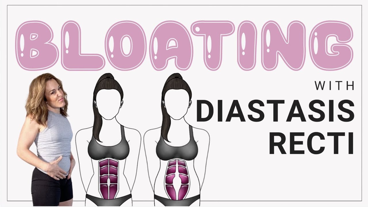 Does Diastasis Recti Cause Bloating Explained Youtube