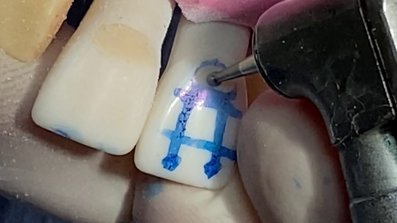 Class V cavity preparation - YouTube