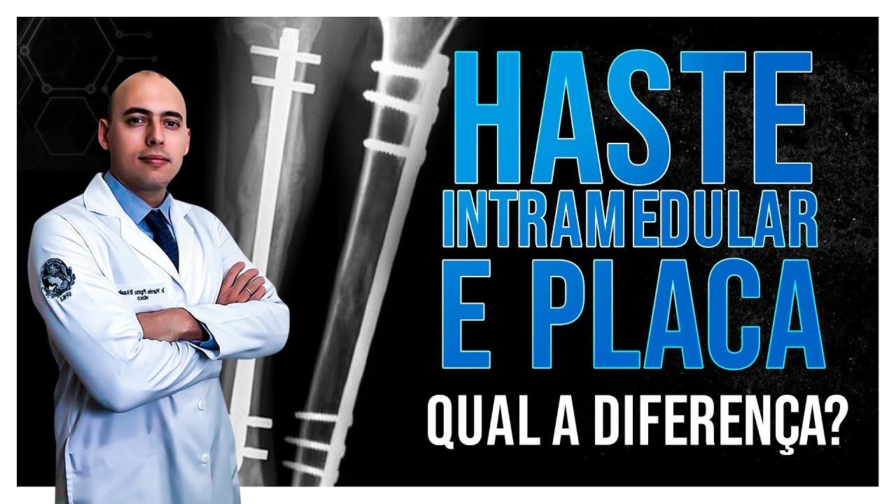 CIRURGIA ORTOPÉDICA | QUAL A DIFERENÇA ENTRE A HASTE INTRAMEDULAR E A ...