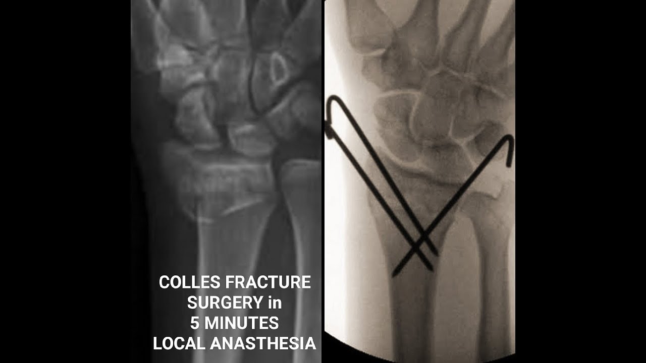 #COLLES #fracture #treatment #Surgery #daycare #wrist_ppain #fall - YouTube