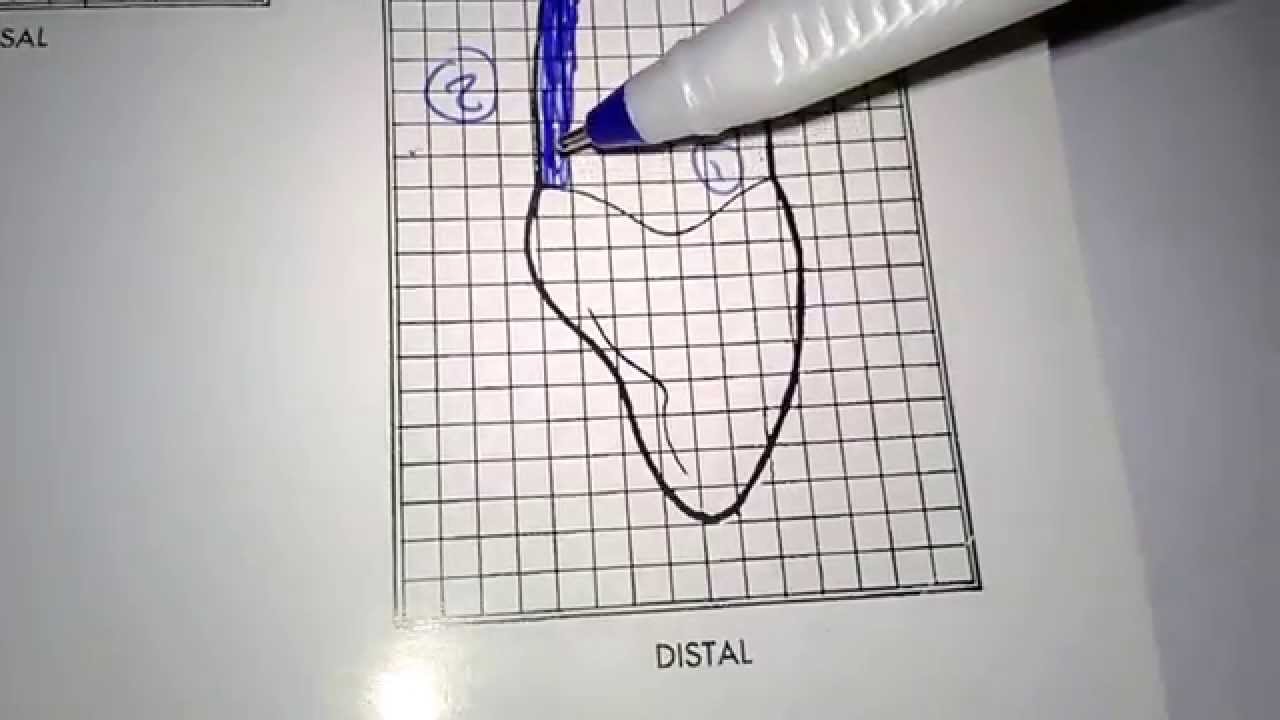 distal aspect maxillary right canine - YouTube
