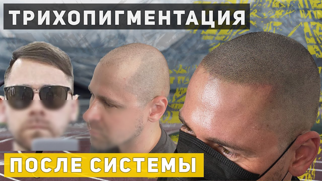 Трихопигментация, татуировка головы после системы волос. Scalp micropigmentation by Andrey ...