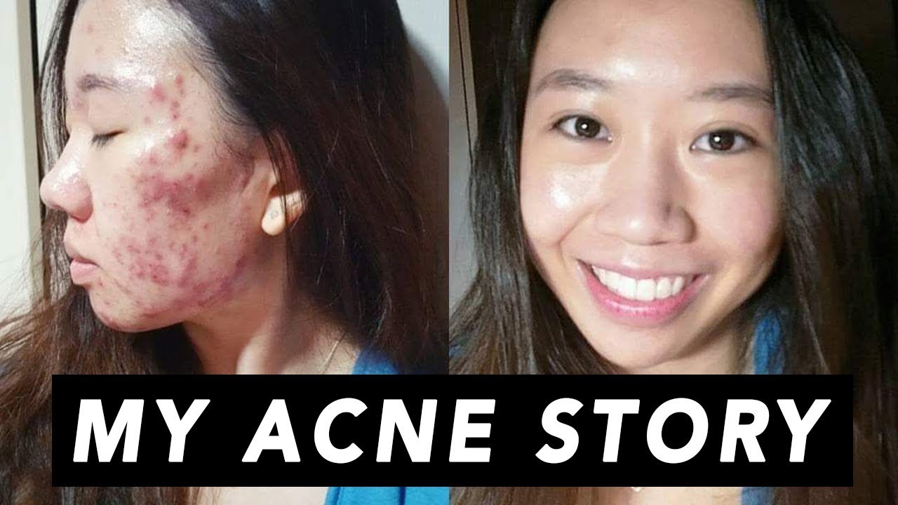 My Full Acne Story Skincare Routine Youtube