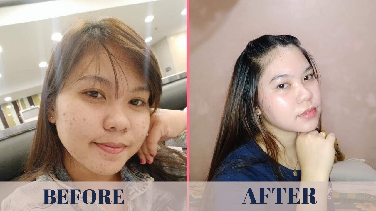 HOW TO GET RID PIMPLES IN JUST A WEEK | GLASS SKIN ACHIEVED | Chichi ...