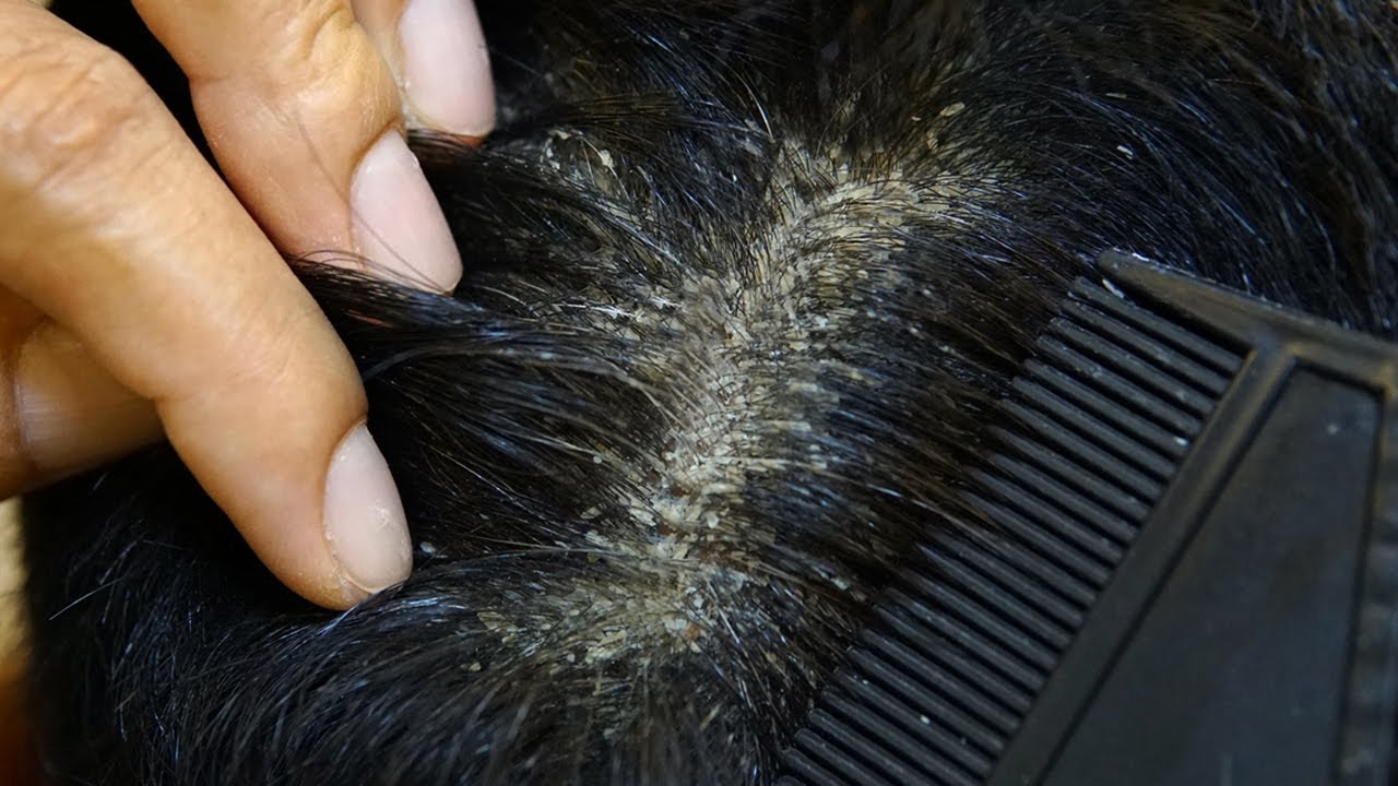 Scalp Scratching Big Flakes Dandruff Scratching Youtube